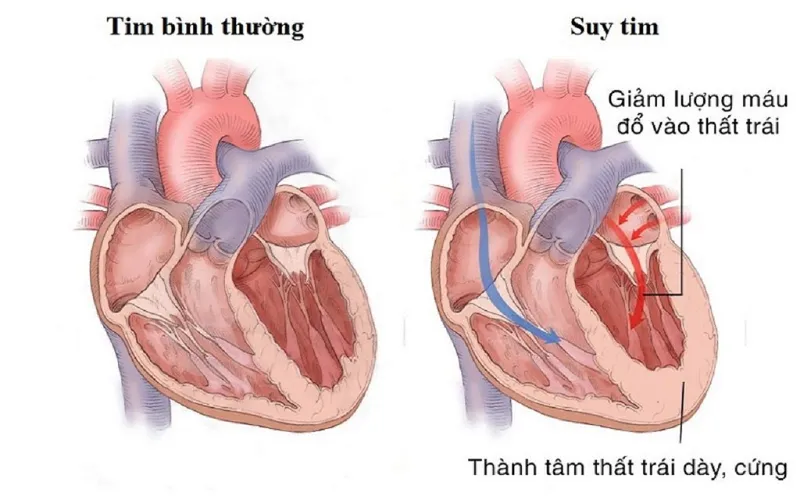 Suy tim mất bù: Nguyên nhân, triệu chứng điều trị và cách phòng ngừa