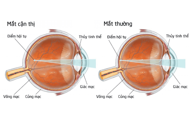 Cận thị là gì? Những điều cần biết về cận thị