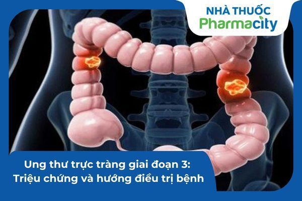 Ung thư trực tràng giai đoạn 3: Triệu chứng và hướng điều trị bệnh