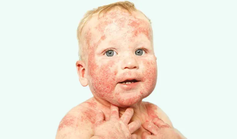 Chàm sữa là bệnh da liễu phổ biến ở trẻ nhỏ