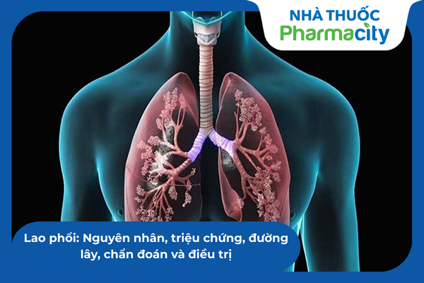 Lao phổi: Nguyên nhân, triệu chứng, đường lây, chẩn đoán và điều trị