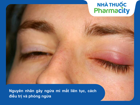 Nguyên nhân gây ngứa mi mắt liên tục, cách điều trị và phòng ngừa